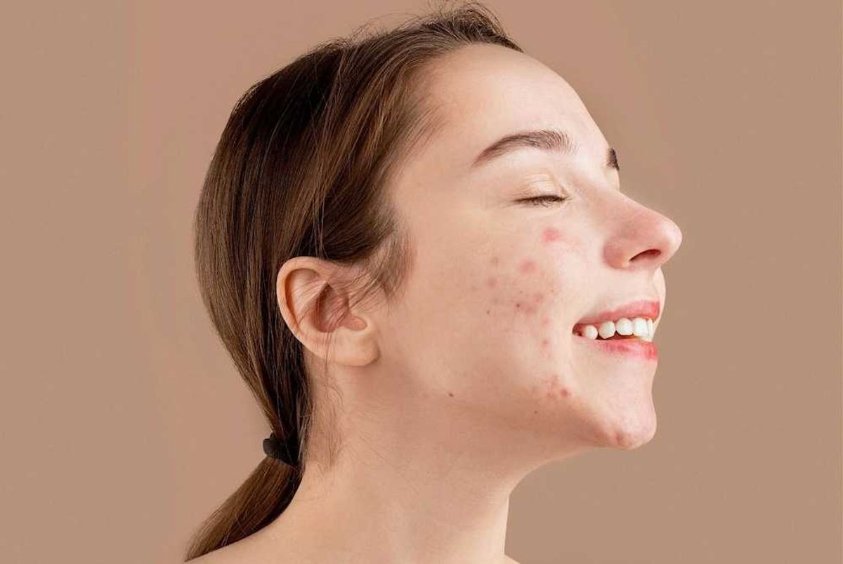 Where Your Skin Breaks Out Means Something — What To Know - Brit + Co